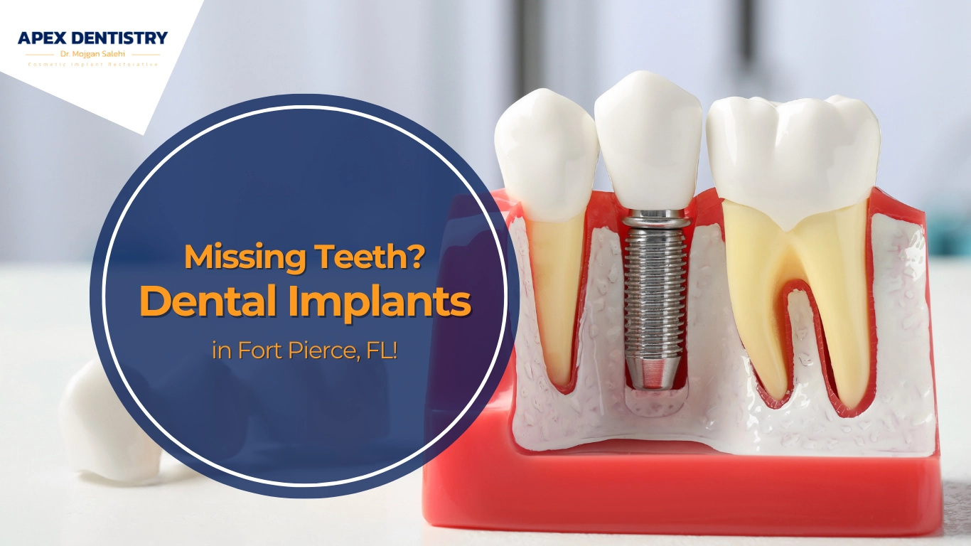 Dental Implants in Fort Pierce, FL - Apex Dentistry